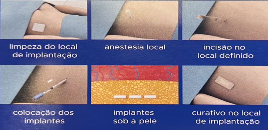Implante – colocação – como funciona – Dra. Nathalia A.M.M.A. CRMSP 145.659